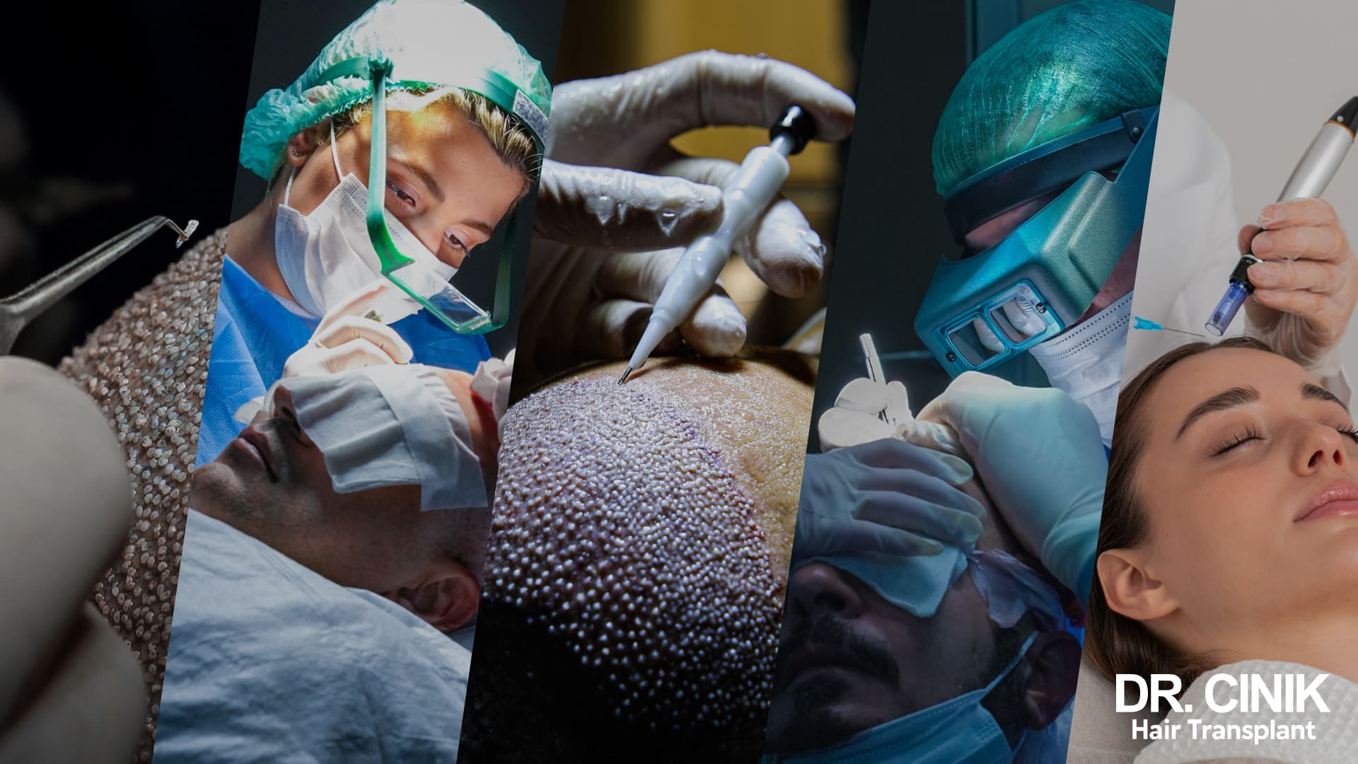 Hair transplant DHI exosome 4250 grafts before after Turkey